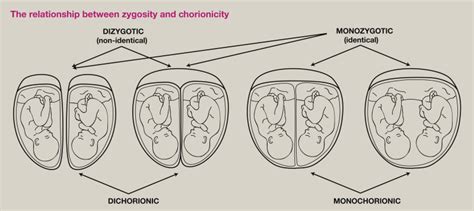 Monochorionic Diamniotic Twins Identical