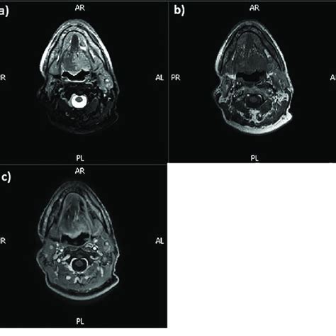 3d T1 Weighted Mri Of A Healthy Volunteer No Gradient Non Linearity Download Scientific