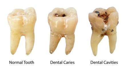 Dont Let A Small Cavity Turn Into A Big Problem Tips From Teravista