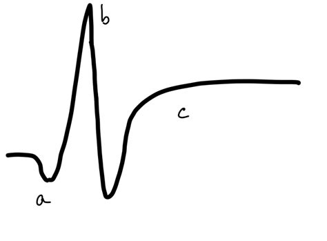 Figure Normal Electroretinogram Contributed By P Parthasarathi Md