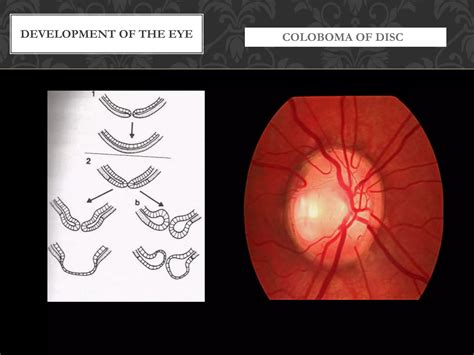 Congenital Malformation Of Optic Nerve And Choroid Pptx