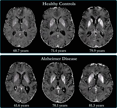 The Biomarkers Of Alzheimers Disease Lifesensors