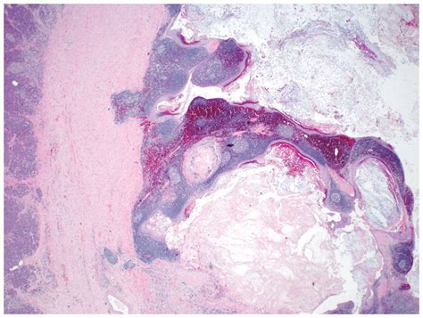 A Lymphoepithelial Cyst Lined By Mature Stratified Squamous Epithelium Download Scientific
