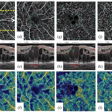 Pdf Stepwise Segmentation Error Correction In Optical Coherence Tomography Angiography Images