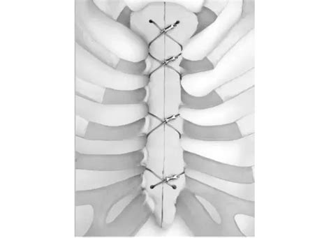 Pioneer Sternal Cable