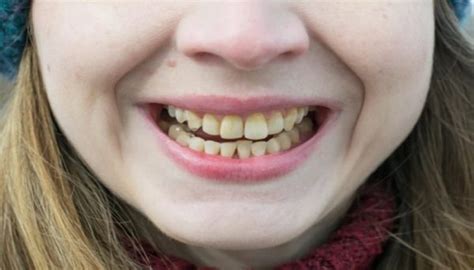 Comparing Dental Fluorosis And Decalcification Grove Dental Clinic