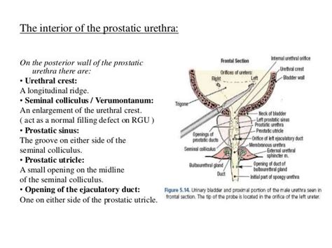 The Double Urethra Revisiting The Surgical Classification Jnpv
