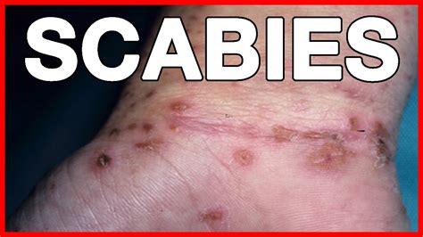 Dermnet Scabies