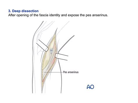 Proximal Tibia Approach Pptx