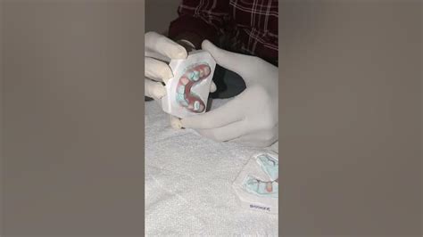 Jacqueline Booker Upper Flexible Partial And Lower Nesbit Bridge