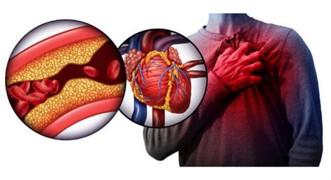 O Infarto Agudo Do Miocárdio é Definido Como Uma Obstrução