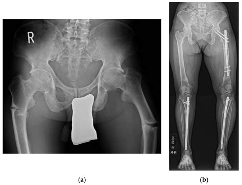 Adult Presentation Of X Linked Hypophosphatemia