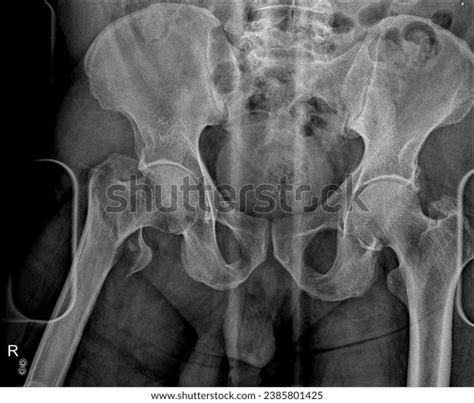 Pelvic Trauma Assessment Images Stock Photos D Objects Vectors Shutterstock