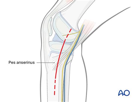 Medial Approach To The Proximal Tibia