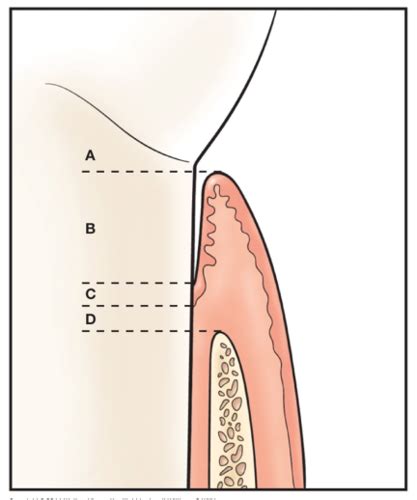 Periodontal Surgery Ch Flashcards Quizlet