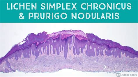 Lichen Simplex Chronicus Histology
