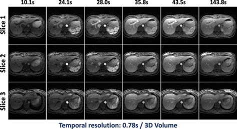 4d Golden‐angle Radial Mri At Subsecond Temporal Resolution Feng 2023 Nmr In Biomedicine