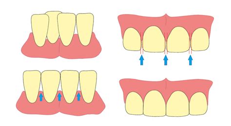 Ipr Dental Interproximal Reduction In Orthodontics 🦷