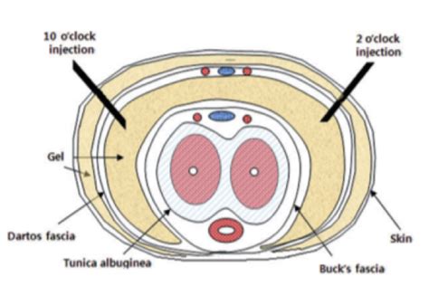 The Truth About Penile Augmentation