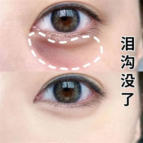 泪沟去除神器改善眼部凹陷填充修复跟泪沟说拜拜祛眼袋提拉遮瑕贴 虎窝淘
