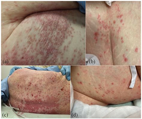 Candidiasis Skin