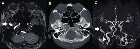 Initial Mra And Ct Of The Brain A Initial Mra Reveals A Dilated