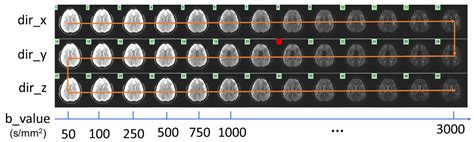 Accelerating High B Value Diffusion Weighted Mri Using A Convolutional Recurrent Neural Network