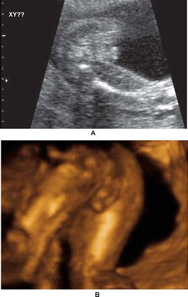Ambiguous Genitalia Ultrasound Ambiguous Genitalia Ultrasound