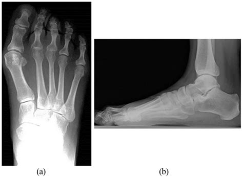 Dislocations Of The Second And Third Metatarsophalangeal Joints After