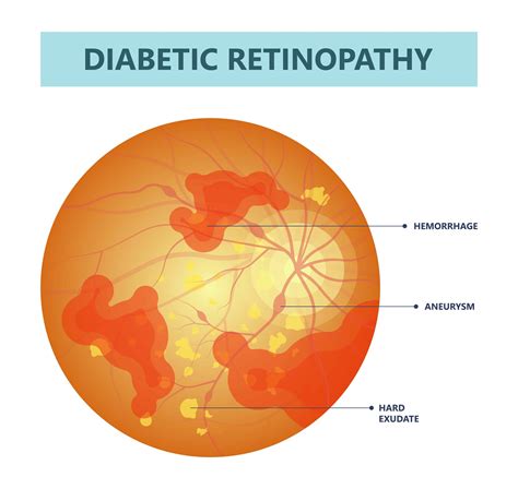 Diabetic Retinopathy Legarreta Eye Care
