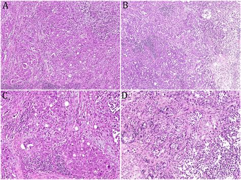 The Lymph Nodes Exhibited Infiltration And Destruction By Highly