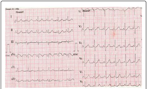 Lgl Syndrome After Conversion To Sinus Rhythm By Adenosine And Propranolol Download