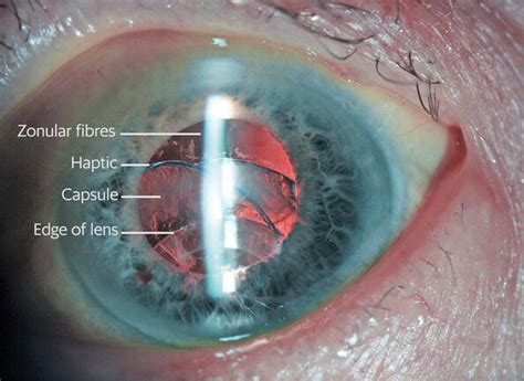 Dislocation Of Intraocular Lens Tidsskrift For Den Norske Legeforening