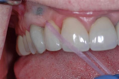 Can You Floss A Bridge At Percy Cunningham Blog