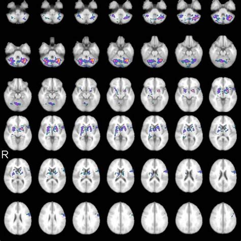 FMRI Female Group Analysis FMRI Map Activation Patterns In The Group Of Download Scientific