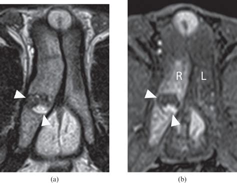 Mri Of The Penis Pmc