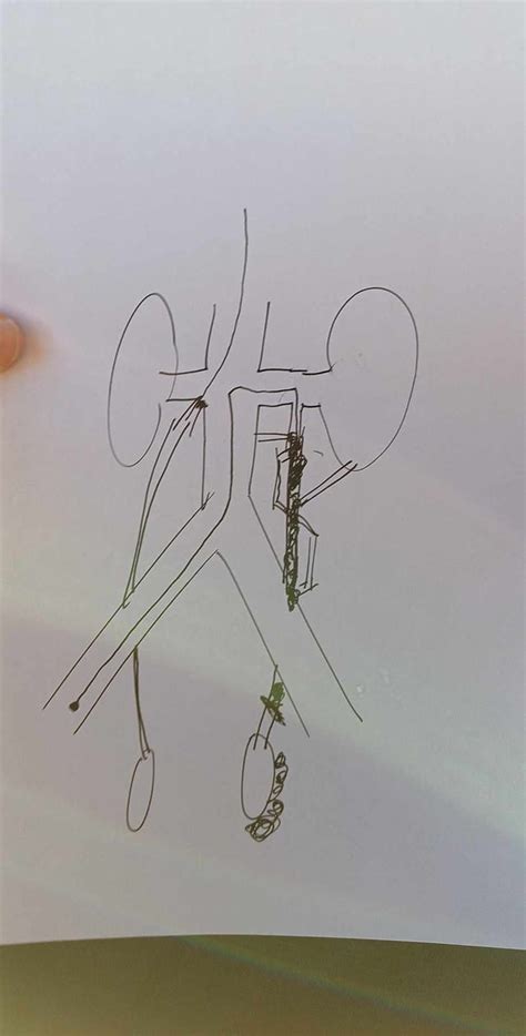 29 Varicocele Embolisation Story Uk Cautiously Optimistic R