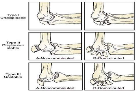 Classifications In Brief Mayo Classification Of Olecranon F Clinical Orthopaedics And