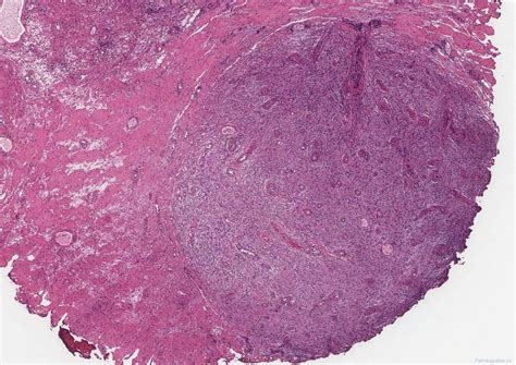 Post Operative Spindle Cell Nodule Of The Bladder Ottawa Atlas Of Pathology