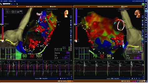 Sinus Rhythm Left Atrial Voltage Map And Radiofrequency Ablation