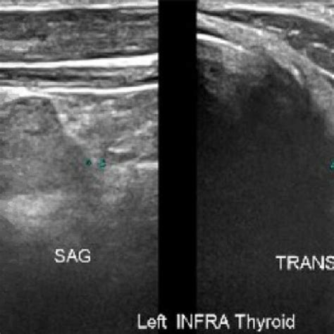 Ultrasound Neck Showing Solid Nodule Inferior To Left Thyroid Lobe Download Scientific Diagram