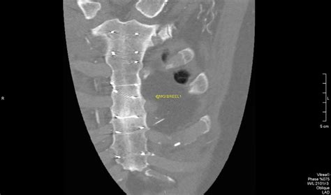Mohamed Gibreel On Linkedin Post Cabg To Be Mentioned Normal Sternal Healing Versus Sternal…