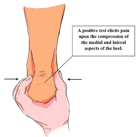 The Calcaneal Squeeze Test Download Scientific Diagram