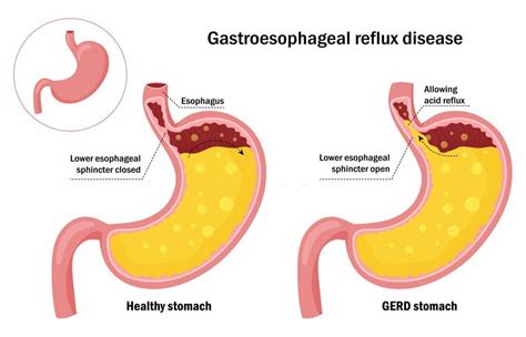 Gerd Treatment In Dubai Expert Solutions For Acid Reflux Relief
