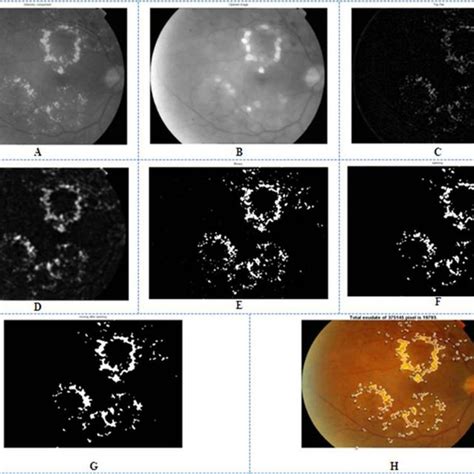 Exudate Detection Of One Sample A The Intensity Component Of Download Scientific Diagram