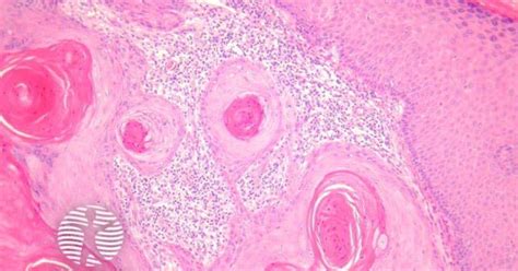 Well Differentiated Squamous Cell Carcinoma Pathology Image