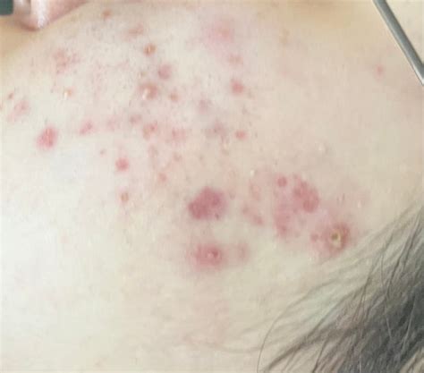 여드름 종류 지식in