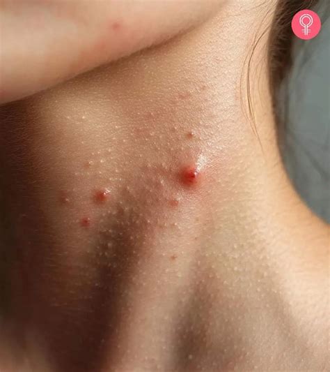 Zits On Back Of Neck How To Get Rid Of Acne On Your Neck Doctors