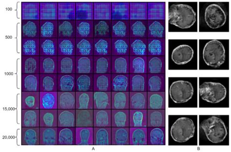 Brain Tumor Classification Using A Combination Of Variational