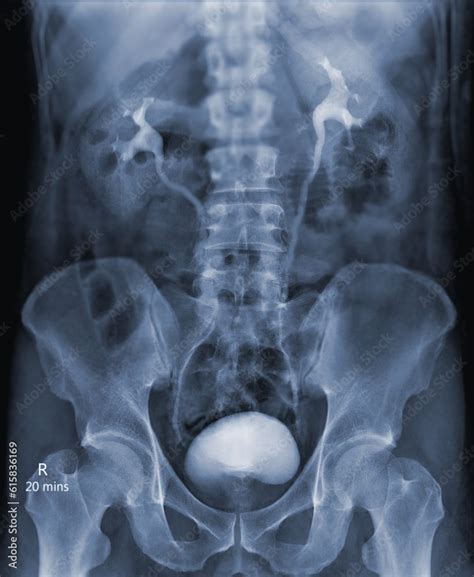 Intravenous Pyelogram Or I V P Is An X Ray Exam Of Urinary Tract After Injection Contrast Media